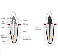 Dental post and core treatment Delhi, India