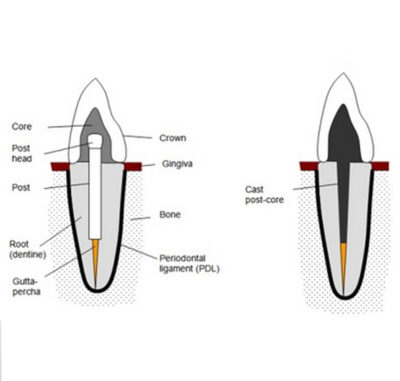 Dental post and core treatment Delhi, India