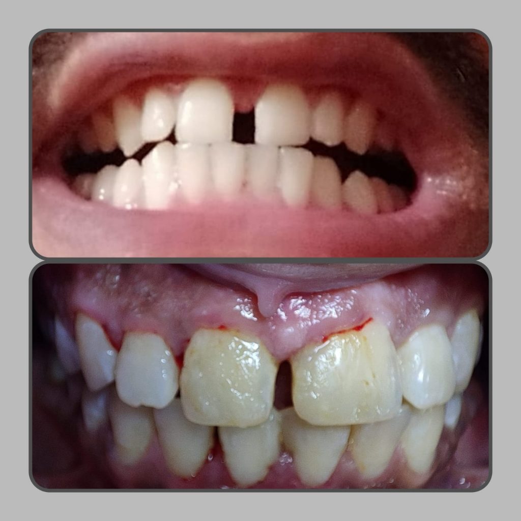 Front teeth gap - Diastema - Dental treatment in Delhi