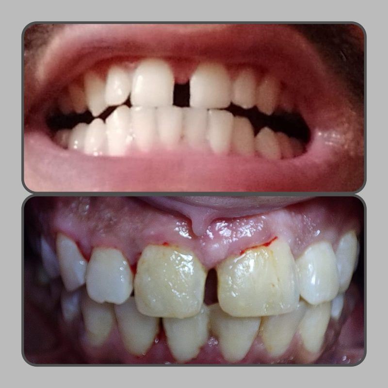 Front teeth gap - Diastema - Dental treatment in Delhi