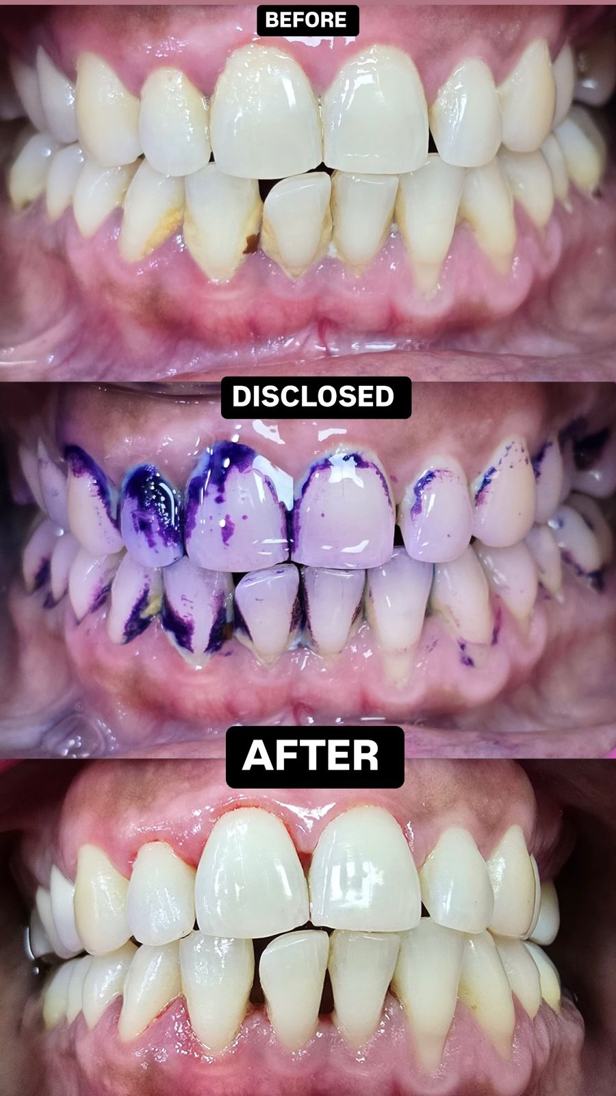 EMS GBT advanced teeth cleaning in DELHI - Goel Dental
