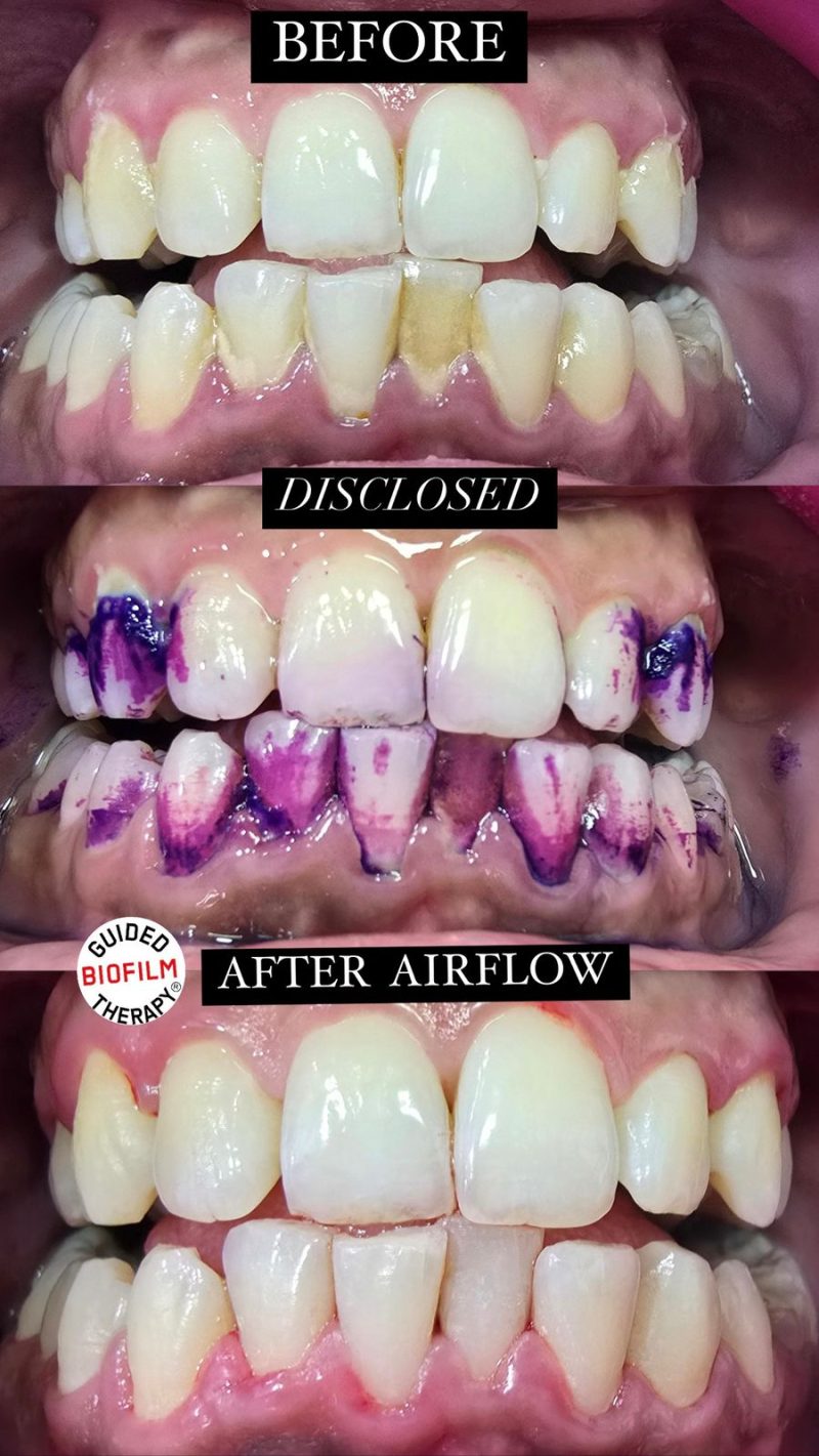 EMS GBT advanced teeth cleaning in DELHI - Goel Dental